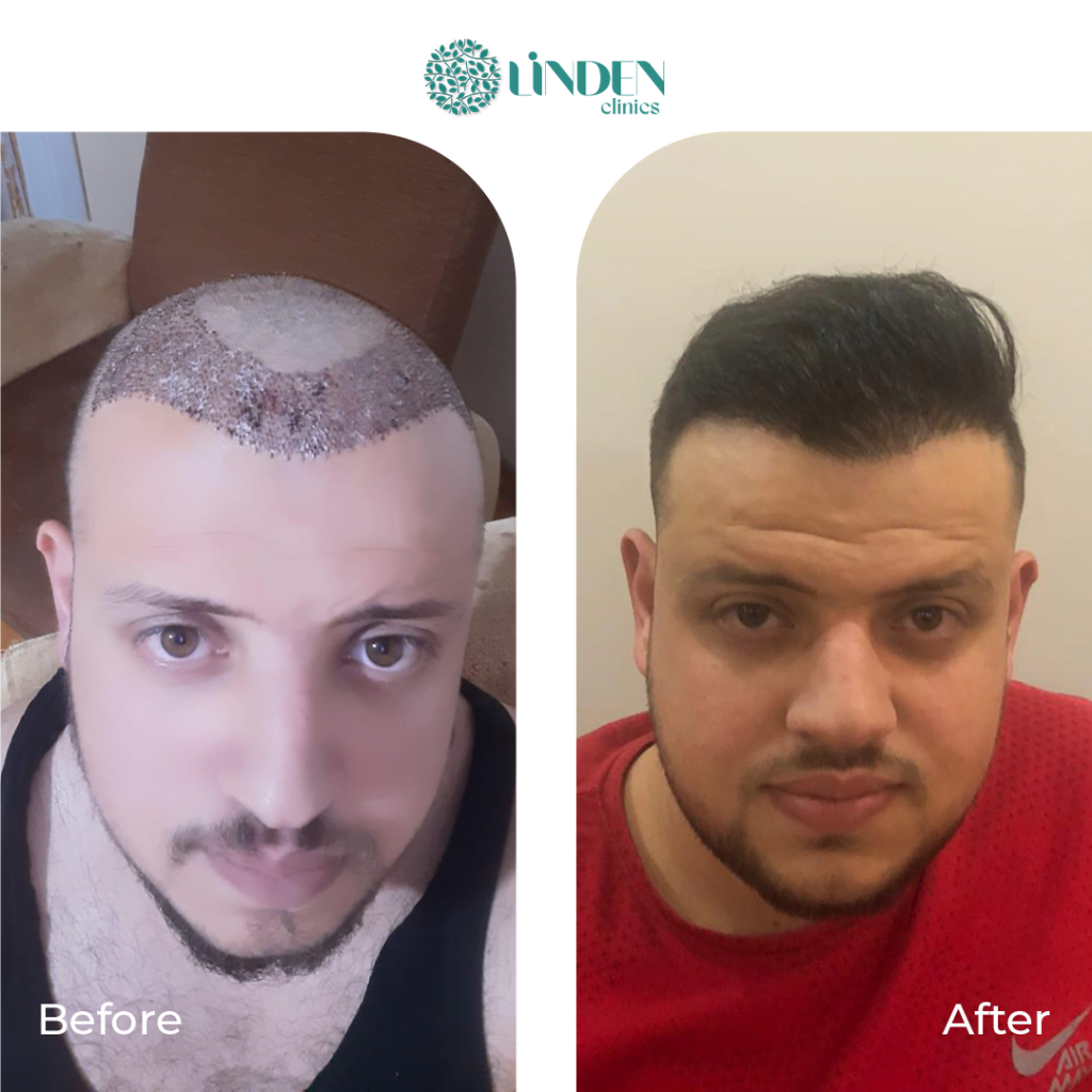 Female Hair Transplant - Linden Clinics